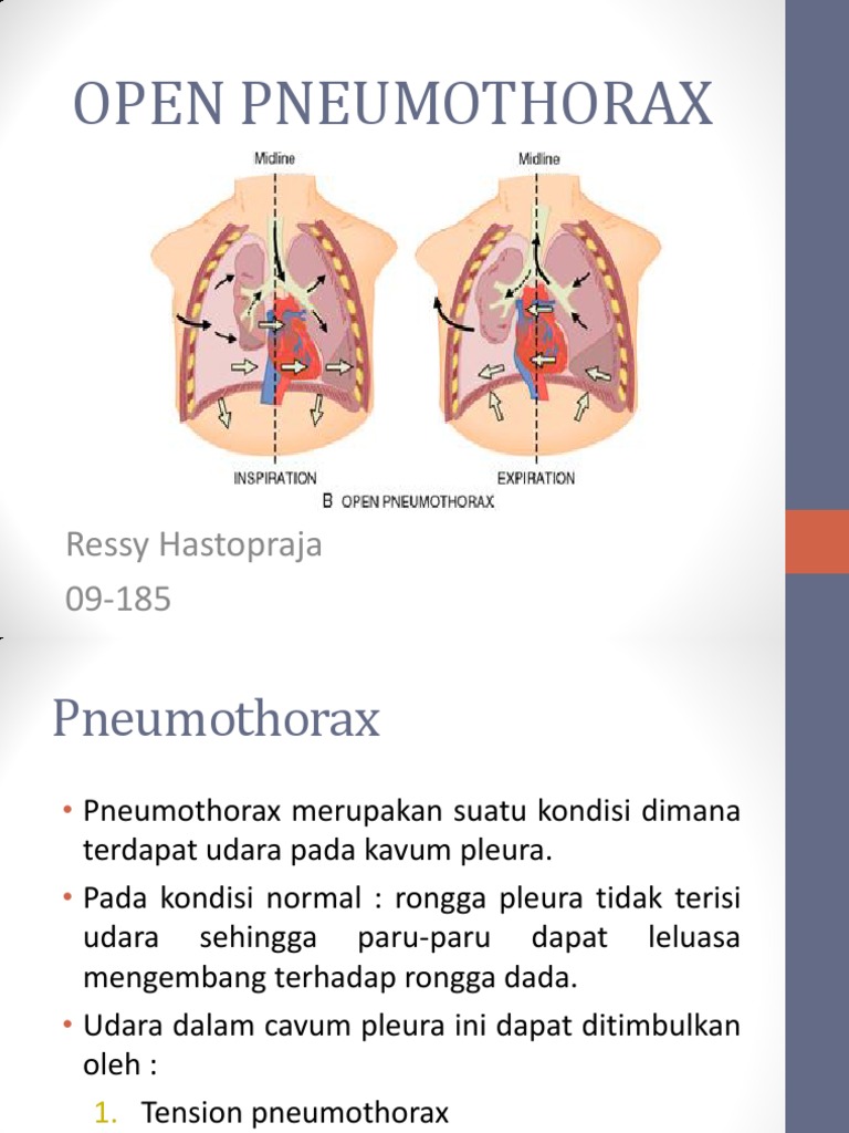 Tindakan Penanganan Open Pneumothorax | PDF