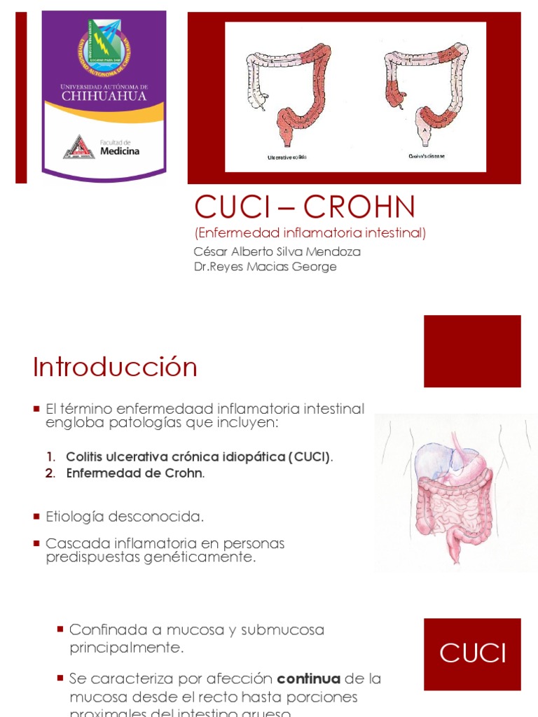 CUCI y Crohn: Diagnóstico y Tratamiento | PDF | Enfermedad de Crohn ...
