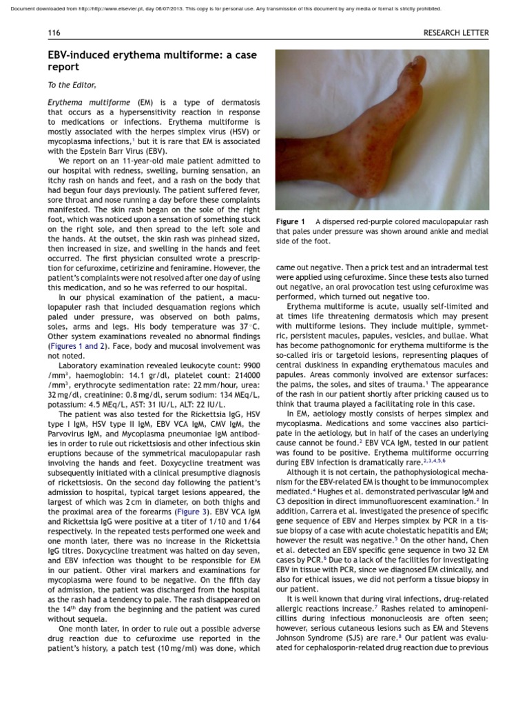 EBV-Related Erythema Multiforme Case Study | PDF | Infection | Diseases ...