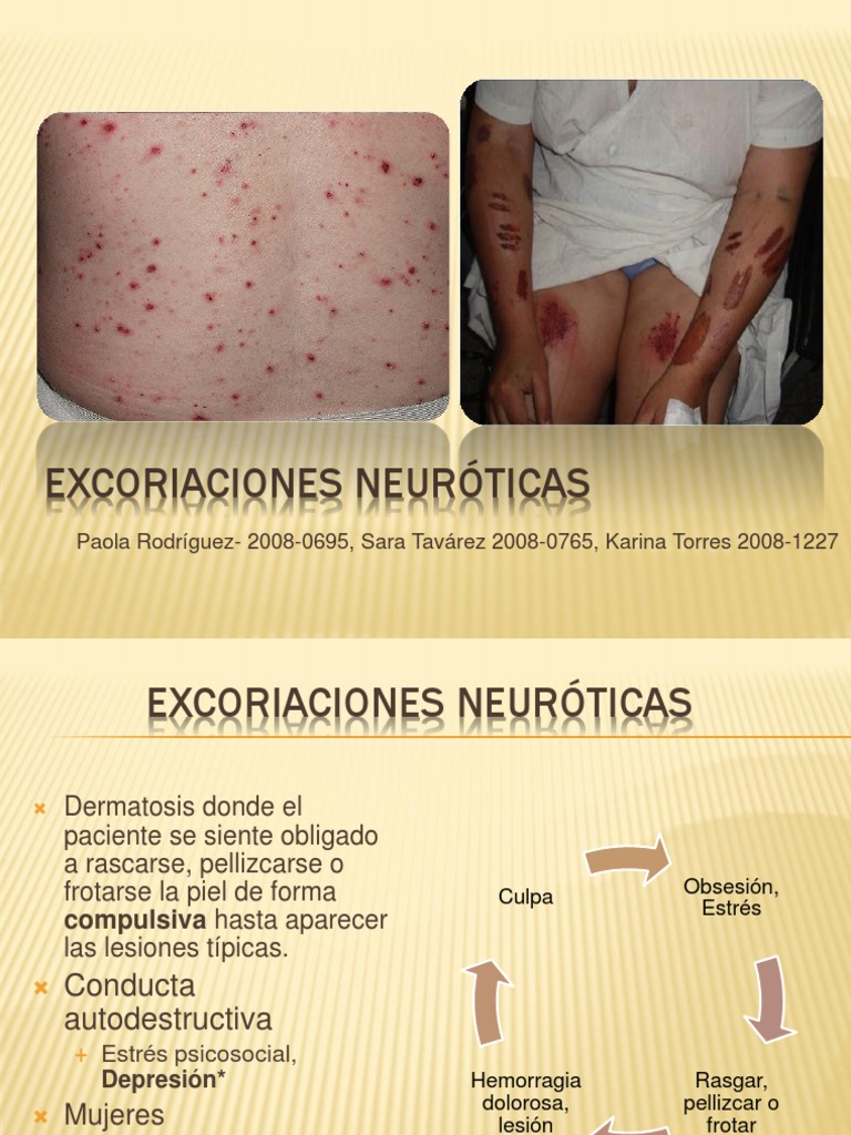 Excoriaciones Neuroticas | PDF | Desorden obsesivo compulsivo | Ansiedad