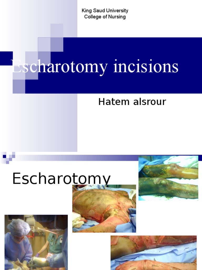 Escharotomy Incisions: Hatem Alsrour | PDF | Surgery | Medical Specialties