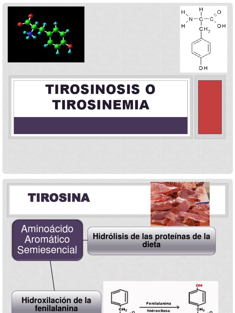 Tirosinosis o Tirosinemia | PDF | Tirosina | Bioquímica