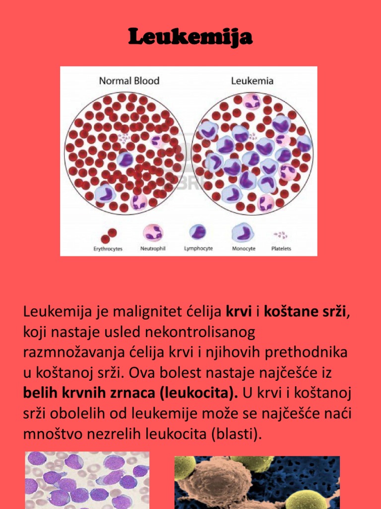 Leukemija | PDF
