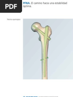 Placa Philos Técnica Cirúrgica | PDF | Tornillo | Cirugía