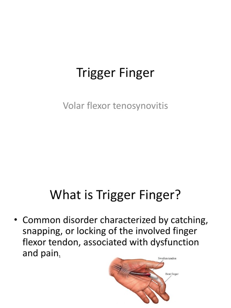 Trigger Finger | PDF