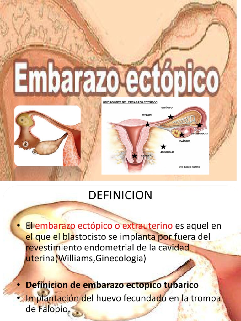 Embarazo Ectopico | PDF | Embarazo humano | El embarazo