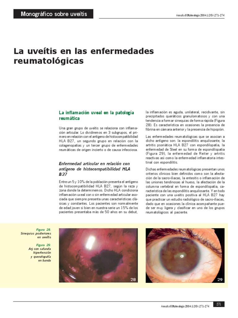Uveitis y Reumatologicas | PDF | Lupus eritematoso sistémico | Inflamación