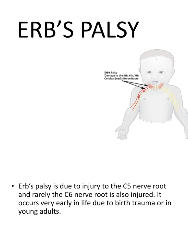 ERB’S PALSY | Nervous System | Musculoskeletal System