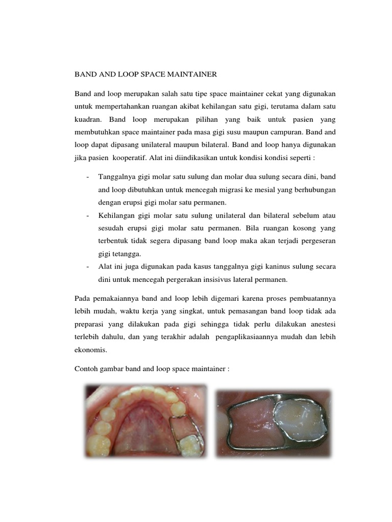 Band and Loop Space Maintainer | PDF