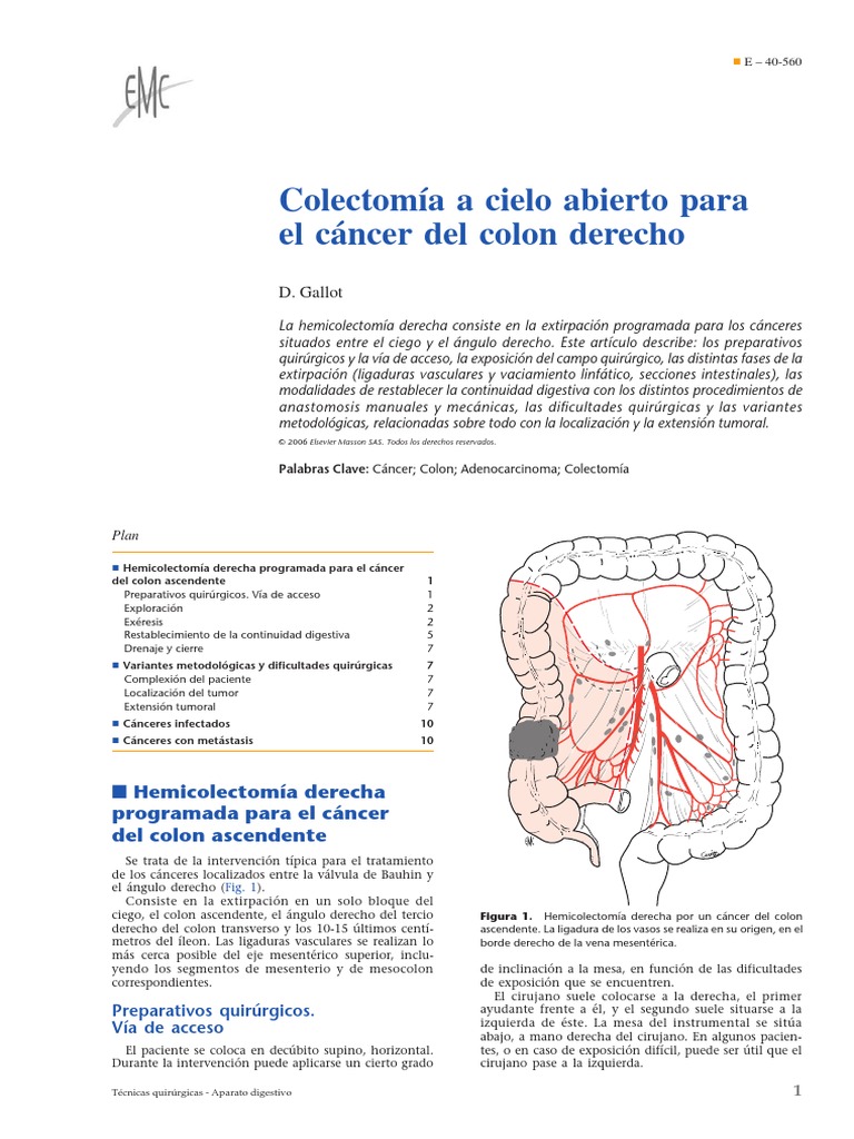 Colectomia A Cielo Abierto para El Cancer de Colon Derecho | PDF ...