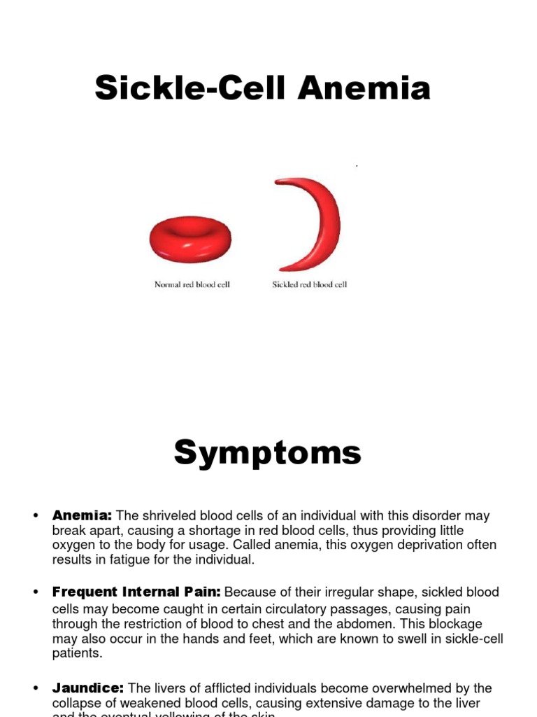 Sickle-Cell Anemia | PDF | Sickle Cell Disease | Anemia