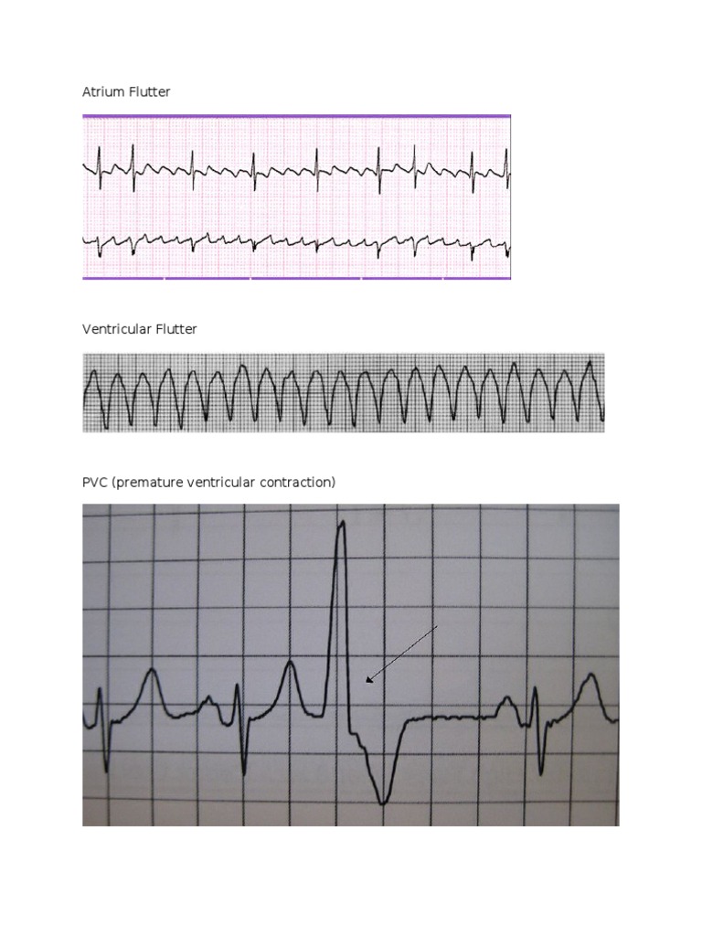 Atrium Flutter | PDF | Angiology | Thorax (Human Anatomy)