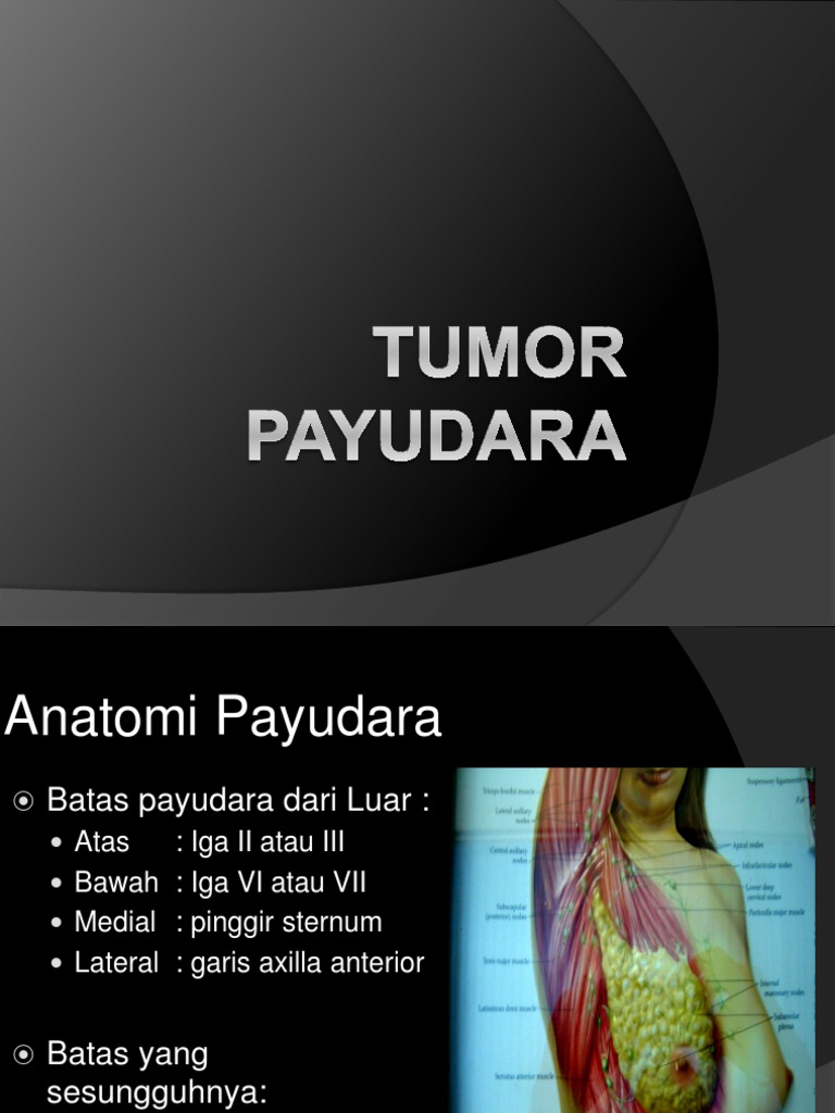 Tumor Payudara | PDF