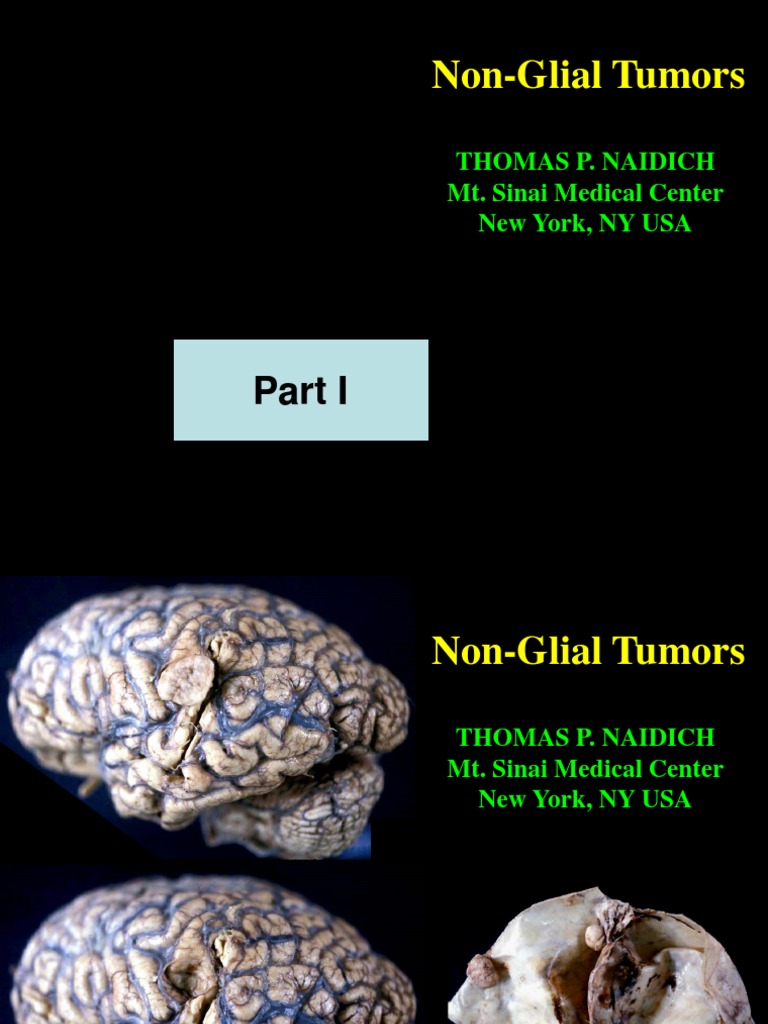 Part I Naidich Non-Astrocytic Tumors | PDF