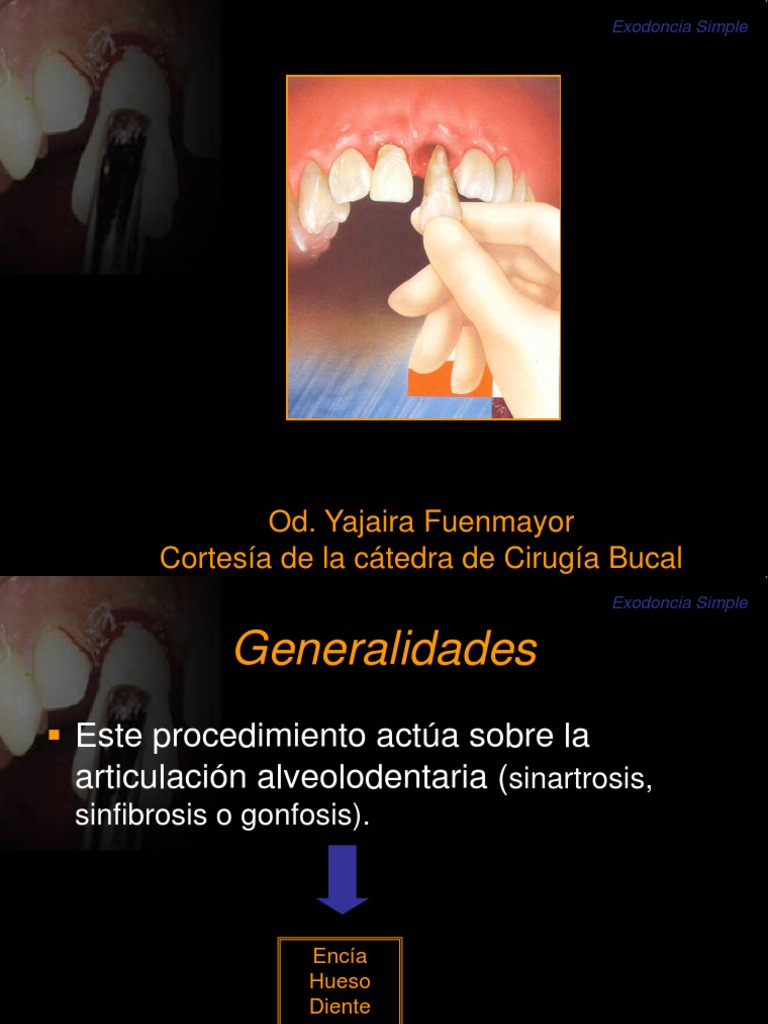 Exodoncia Simple(2) | Diente humano | Odontología