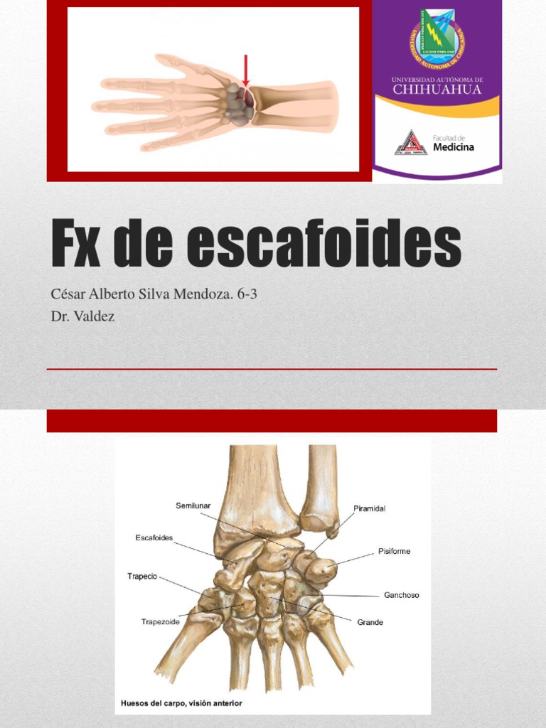 FX de Escafoides | Anatomía humana | Enfermedades y trastornos
