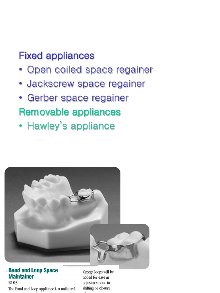 Fixed Appliances - Open Coiled Space Regainer - Jackscrew Space ...
