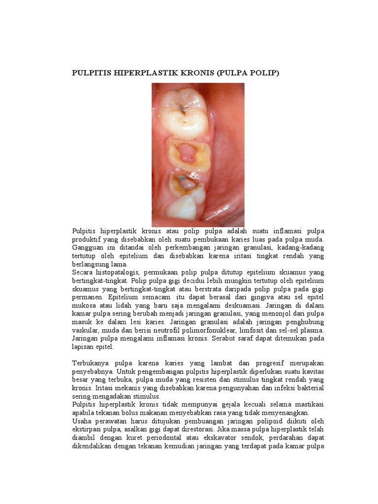 Pulpitis Hiperplastik Kronis | PDF | Kesehatan Holistik