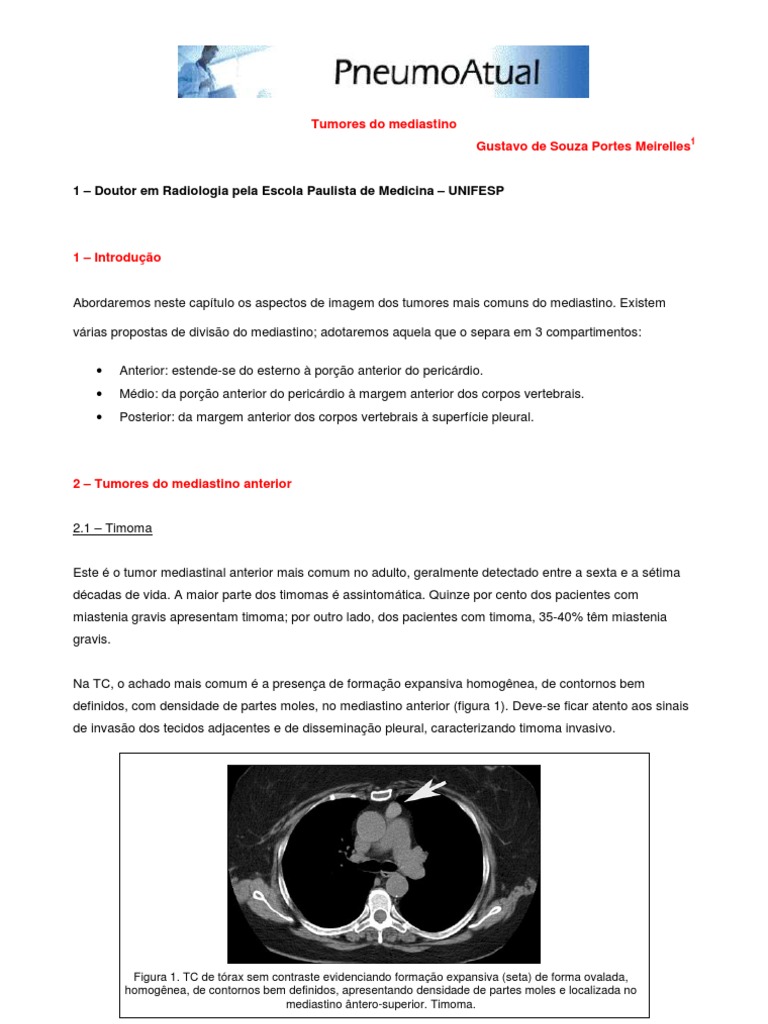 Tumores de Mediastino | Download grátis PDF | Linfoma | Câncer