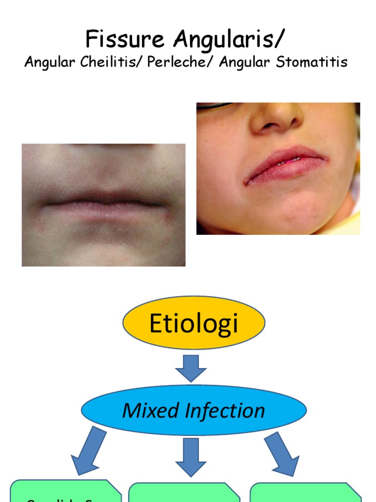 Fissure Angularis | PDF