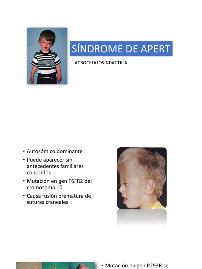 Síndrome De Apert Pdf