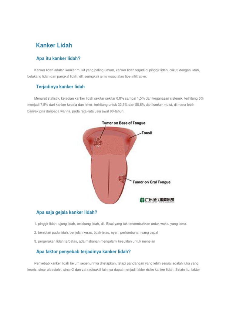 Kanker Lidah | PDF