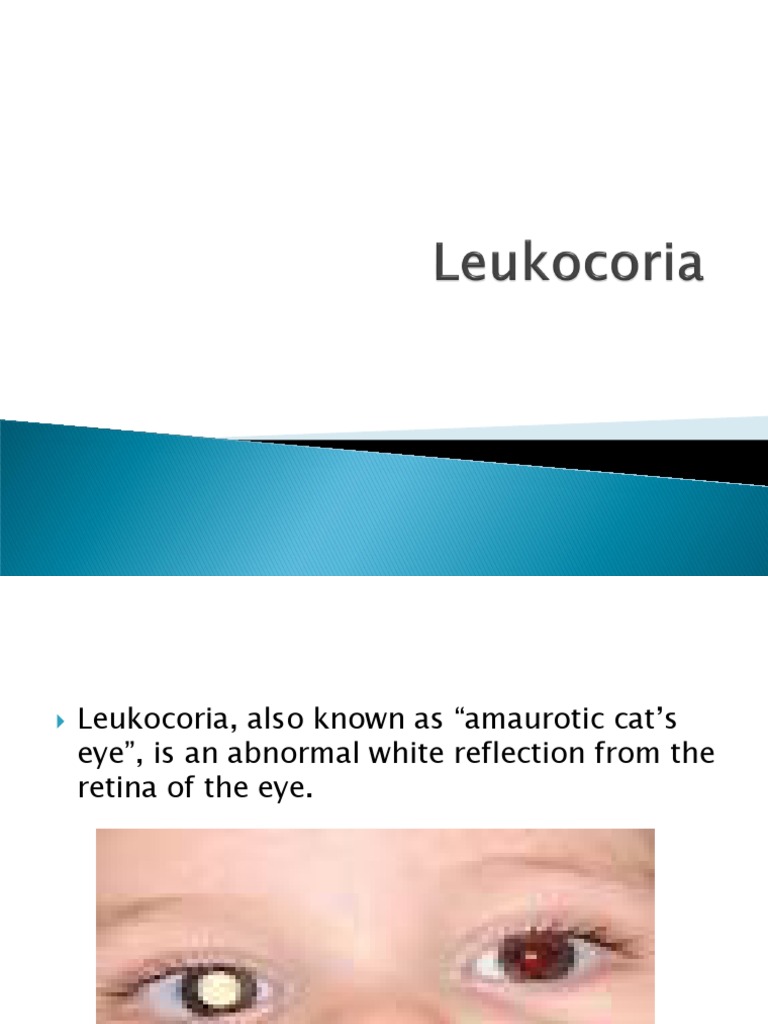 Leukocoria | PDF | Human Eye | Cataract