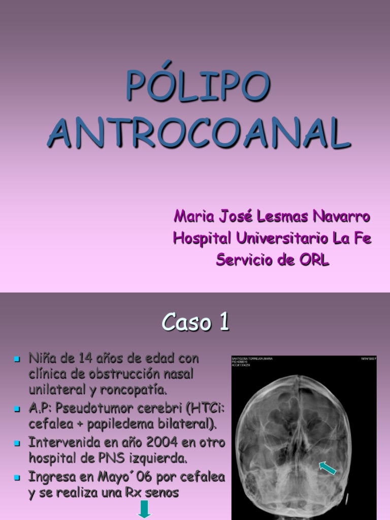 Polipo Antrocoanal | PDF | Pecho | Medicina CLINICA