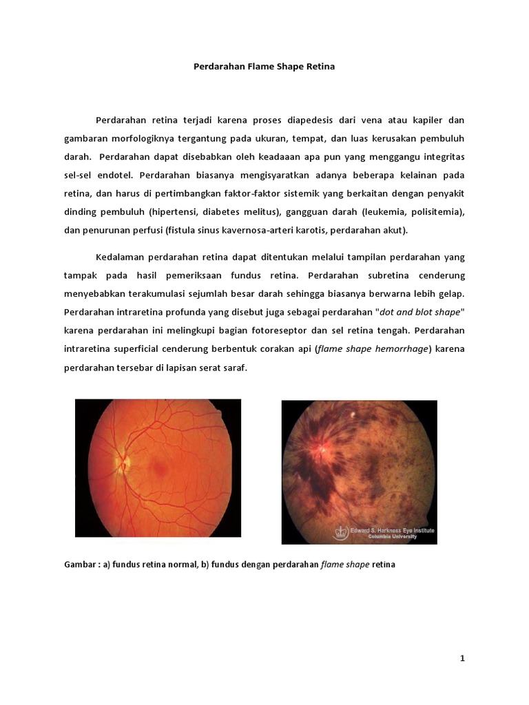 Perdarahan Retina | PDF