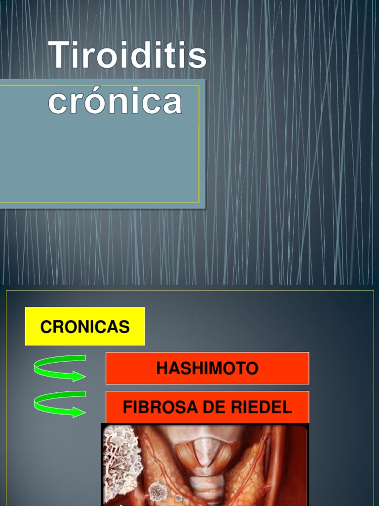 Tiroiditis Crónica: Hashimoto y Riedel | PDF | Hipotiroidismo | Tiroides