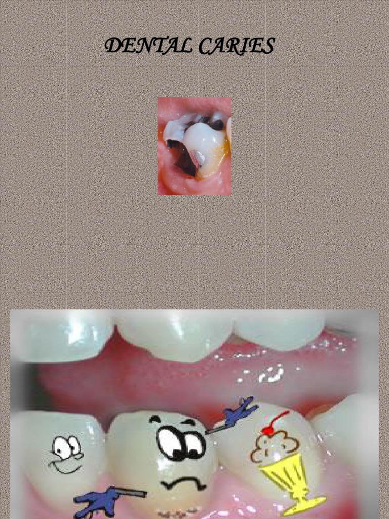 Dental Caries | PDF | Tooth Enamel | Dentin