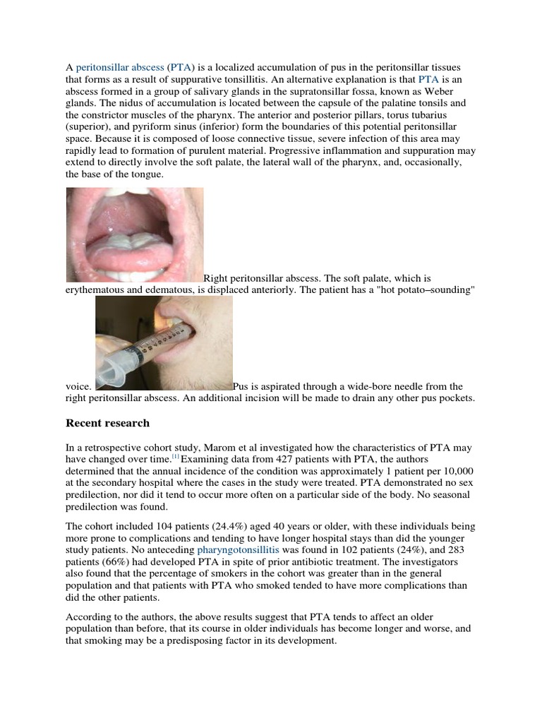 A Peritonsillar Abscess | Download Free PDF | Common Carotid Artery ...