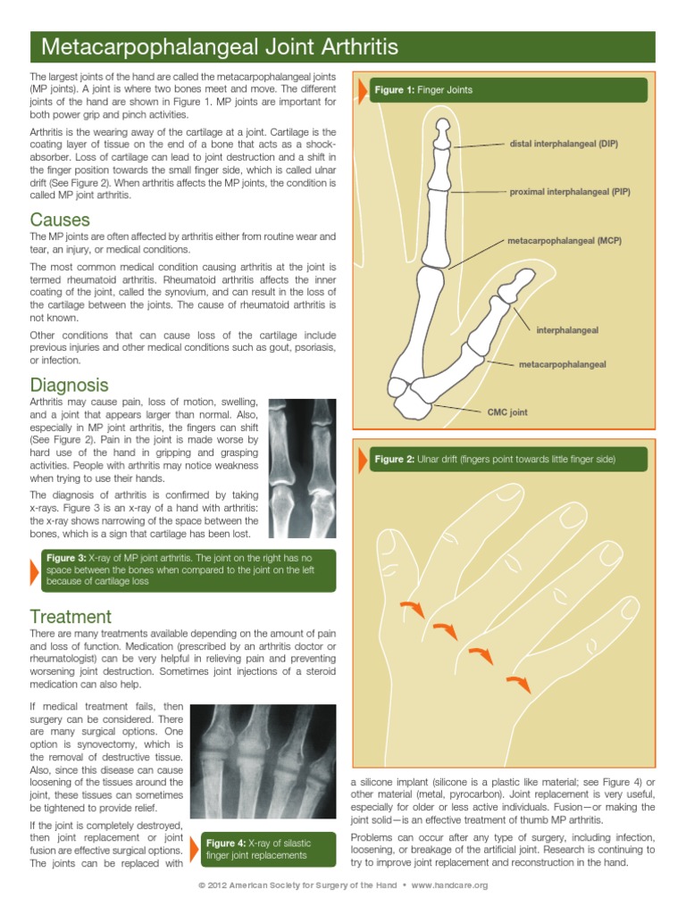Mp Joint | Arthritis | Joint