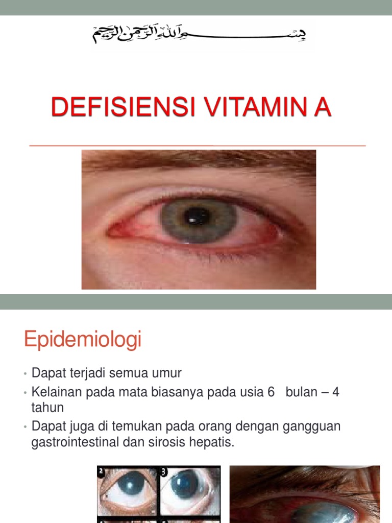 Presentation Defisiensi Vitamin A | PDF