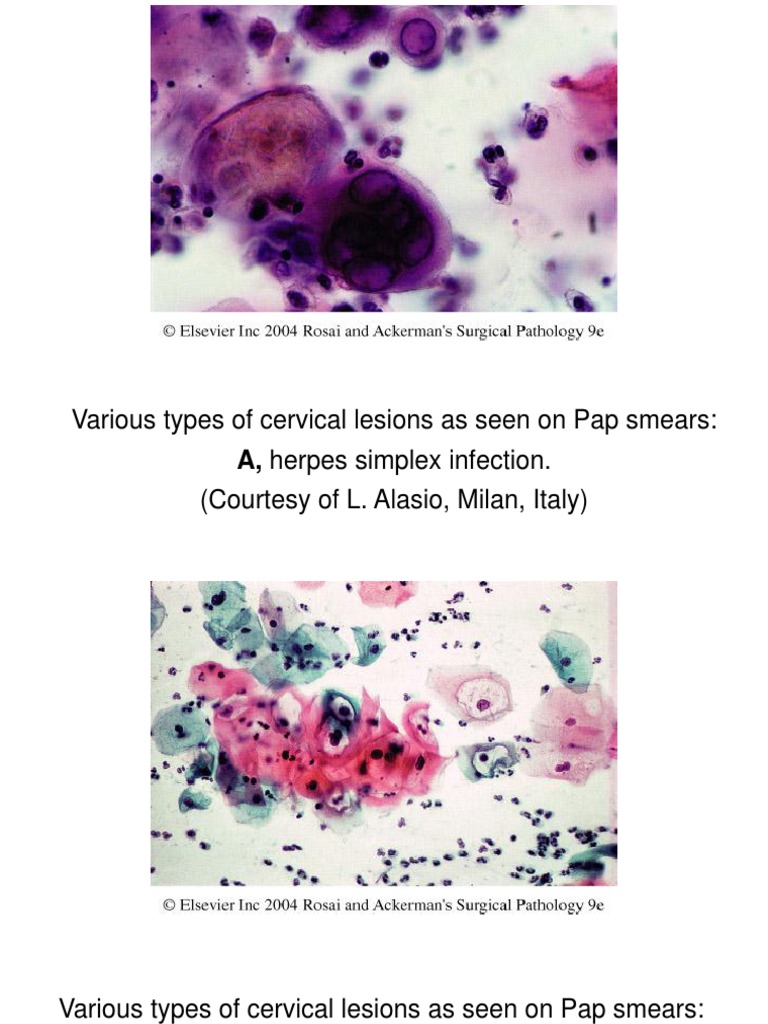 Various Types of Cervical Lesions As Seen On Pap Smears: A, Herpes ...