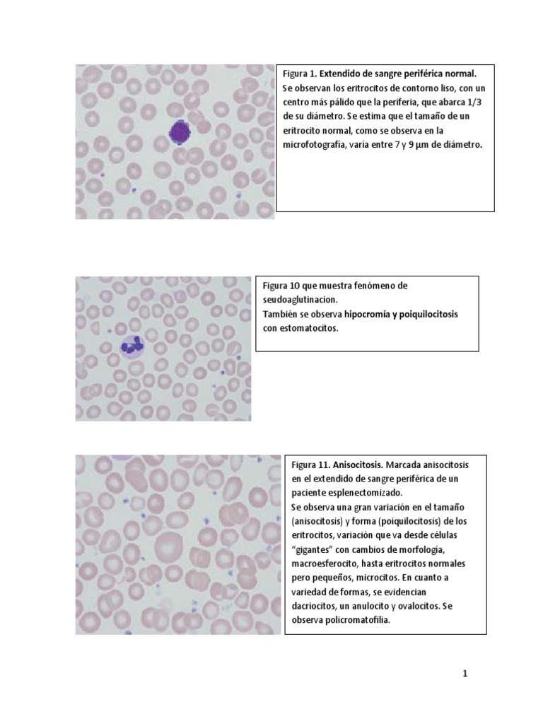 Anisocitosis | Ácido fólico | Anemia