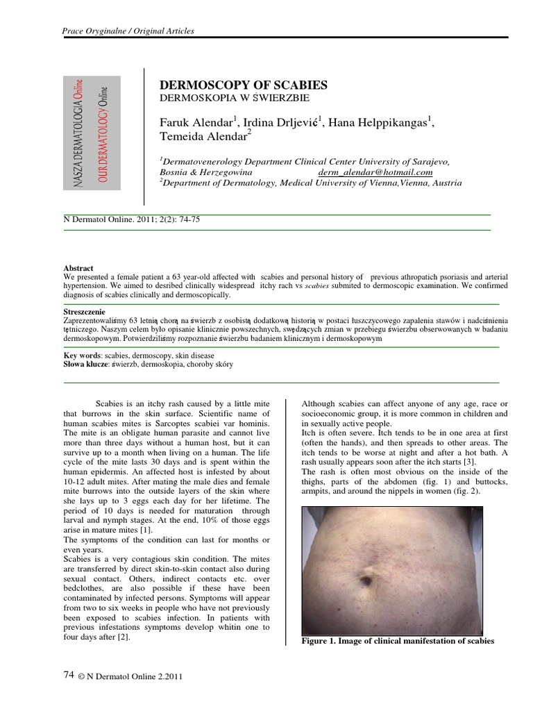8_dermoscopy of Scabie | Cutaneous Conditions | Clinical Medicine