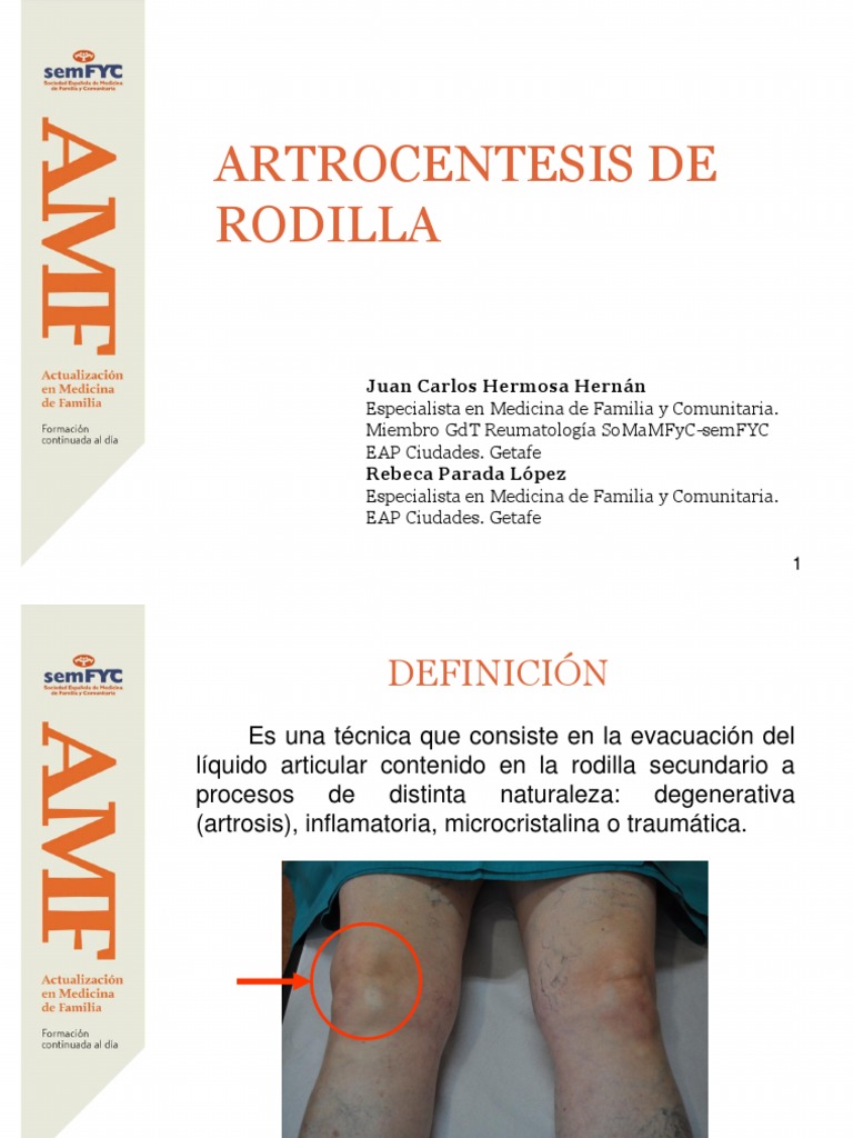 Artrocentesis | PDF | Rodilla | Especialidades Medicas