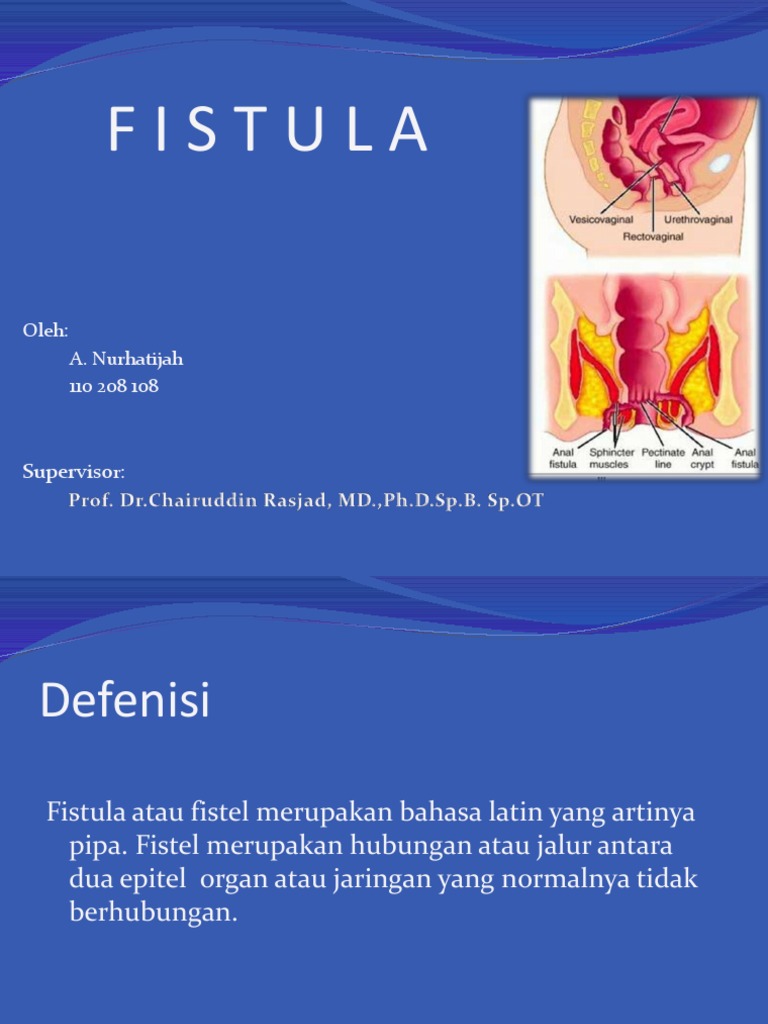 Fistula