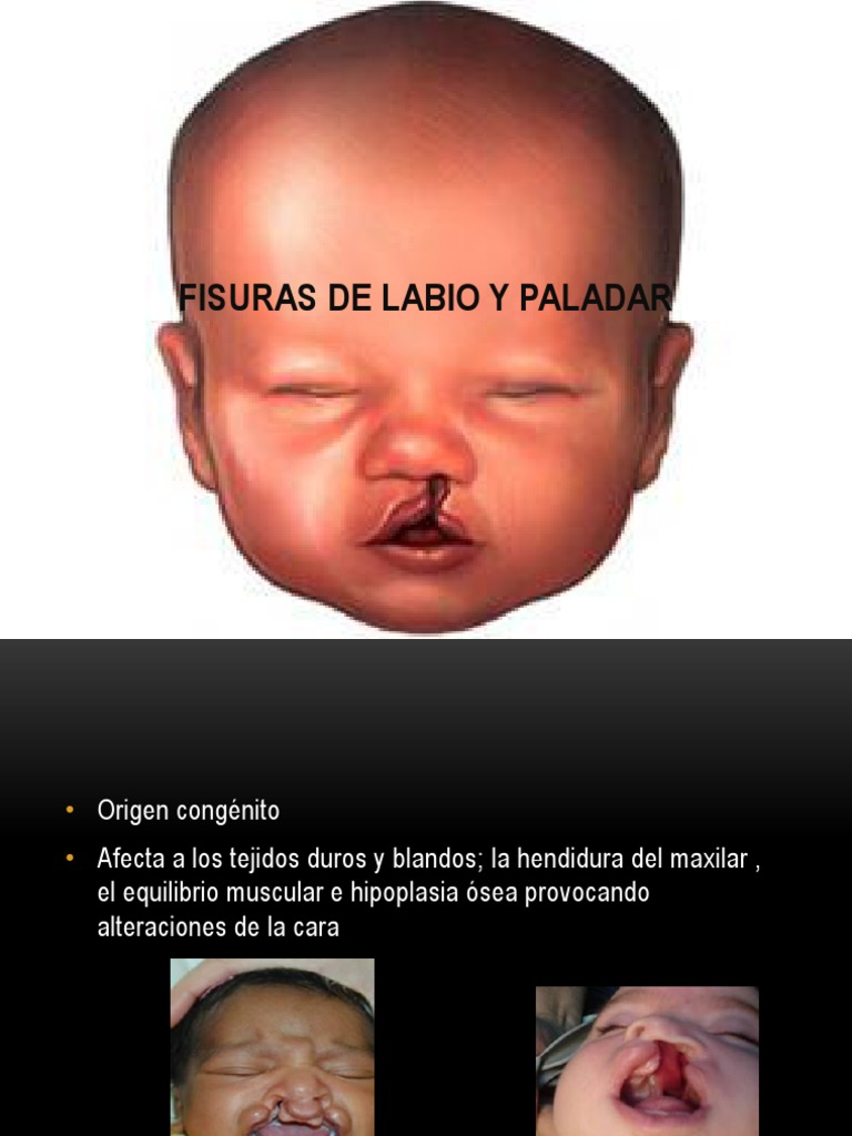 Fisuras de Labio y Paladar | PDF | Anatomía de los primates | Cara