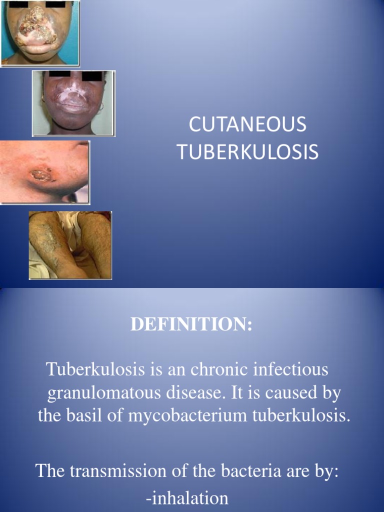 TB Kutis Print | PDF | Mycobacterium Tuberculosis | Tuberculosis