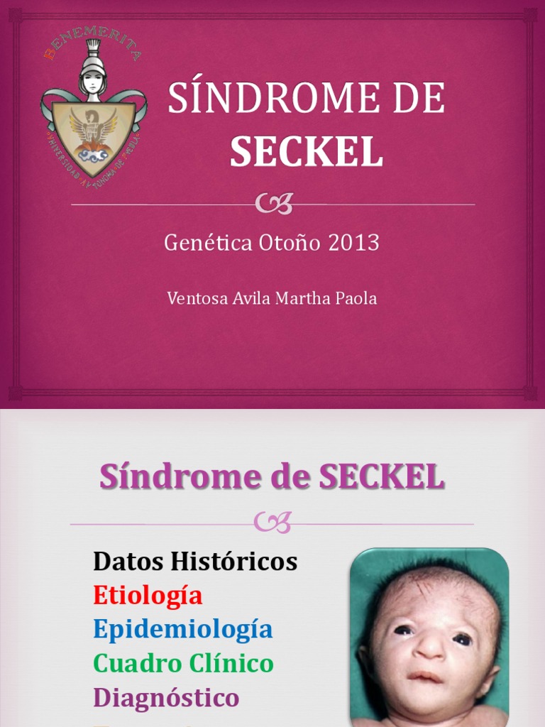 An in-depth overview of the Seckel syndrome including its history ...