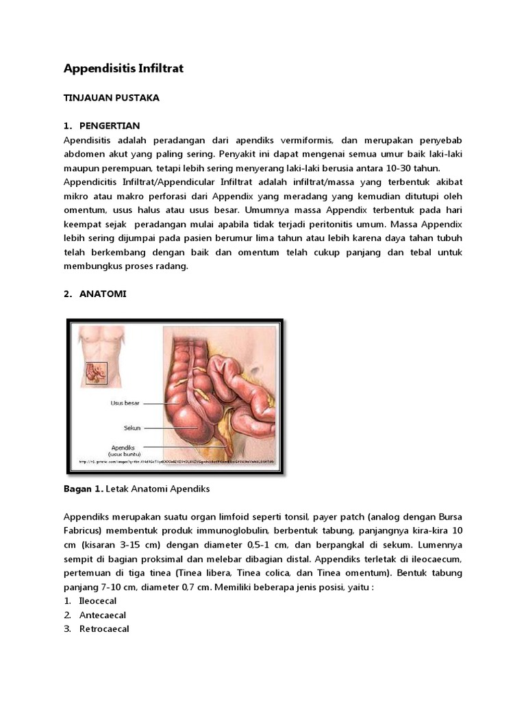 Appendisitis Infiltrat - Tinjauan Pustaka | PDF