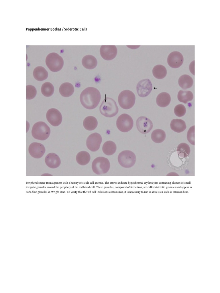 Pappenheimer Bodies | Red Blood Cell | Anemia