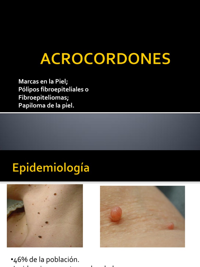 Guía sobre Acrocordones y Tratamientos | PDF