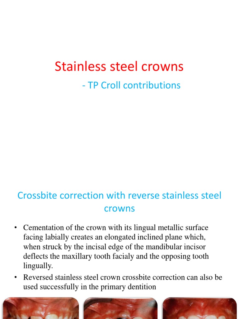 Stainless Steel Crowns | PDF | Dentistry | Mouth