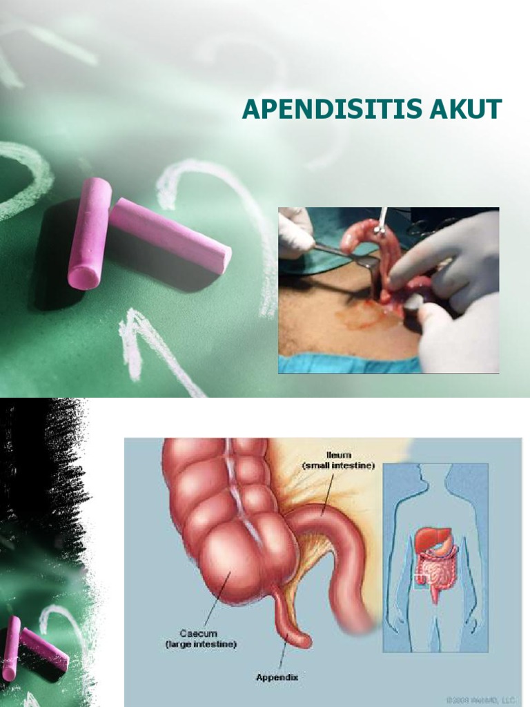 Apendisitis Akut | PDF