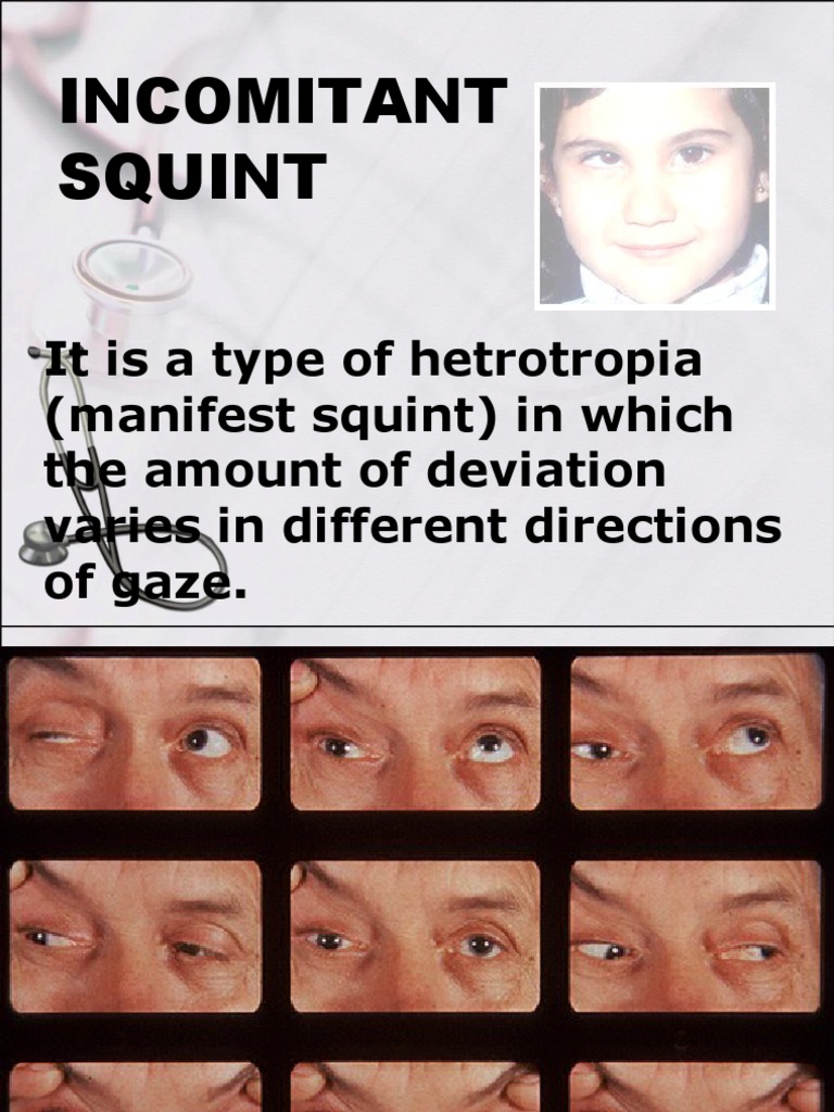 Incomitant Squint | Download Free PDF | Eye | Diseases Of The Eye And ...
