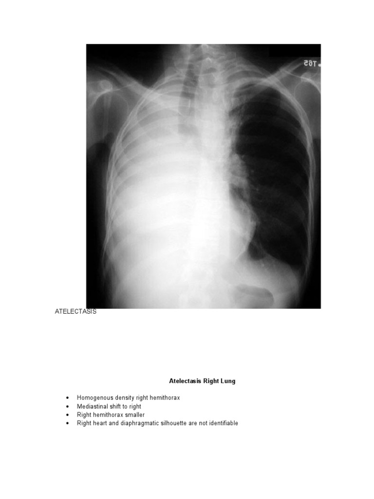 Atelectasis | PDF | Lung | Organ (Anatomy)