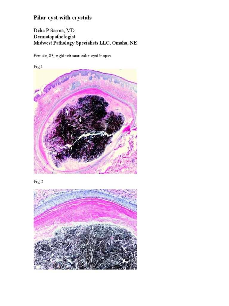 Pilar Cyst With Crystals | PDF